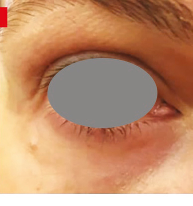 Smooth Eye - Clinique Laser du Parc Wattignies